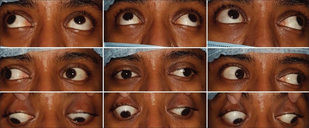 Squint (Strabismus) Treatment – Align Your Vision